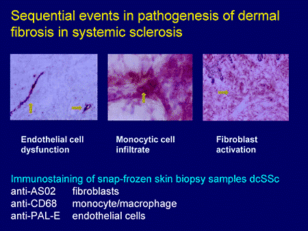 Systemic Sclerosis: An Integrated Approach to Understanding ...