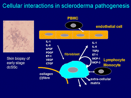 Systemic Sclerosis: An Integrated Approach to Understanding ...