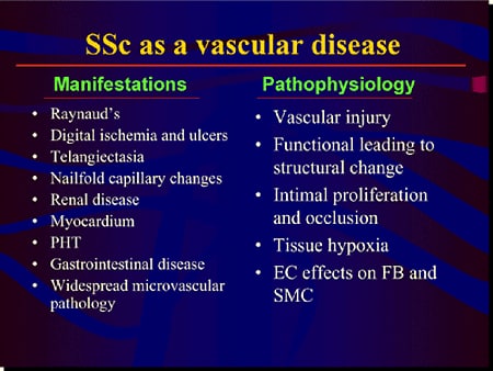 Systemic Sclerosis: An Integrated Approach to Understanding ...
