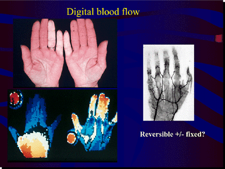 Systemic Sclerosis: An Integrated Approach to Understanding ...