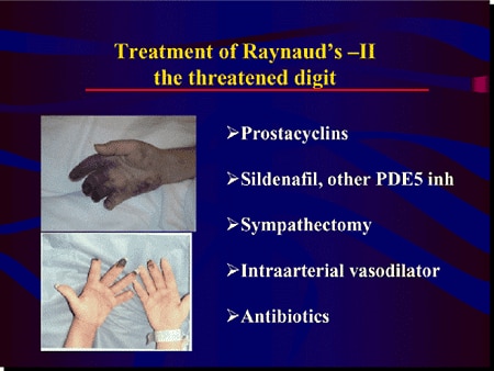 Systemic Sclerosis: An Integrated Approach to Understanding ...