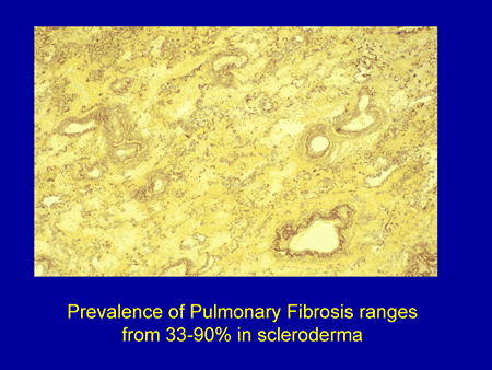 Systemic Sclerosis: An Integrated Approach to Understanding ...