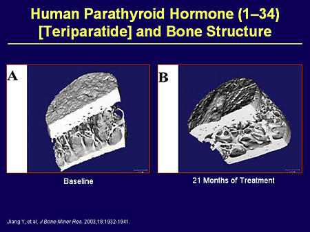 Optimizing Treatment of Osteoporosis: Evolutions and Solutions