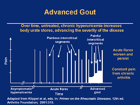 Hyperuricemia and Gout