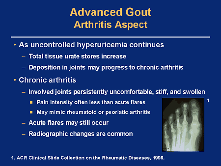 Hyperuricemia and Gout