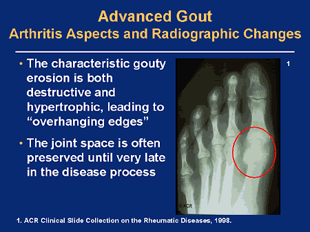 Hyperuricemia and Gout
