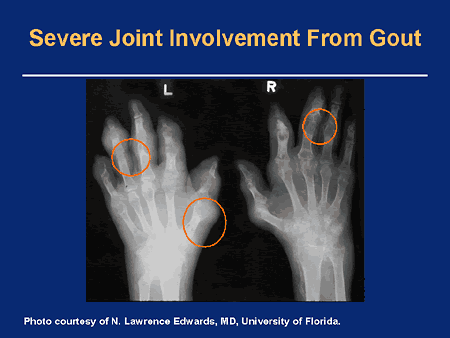Hyperuricemia and Gout