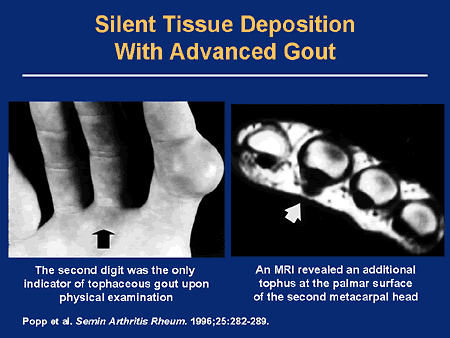 Hyperuricemia and Gout