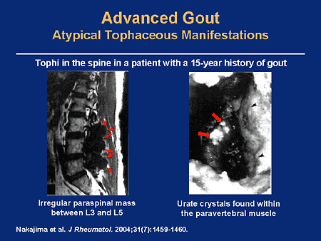 Hyperuricemia and Gout