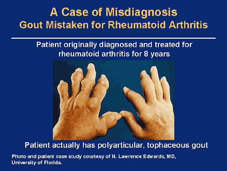 Hyperuricemia and Gout