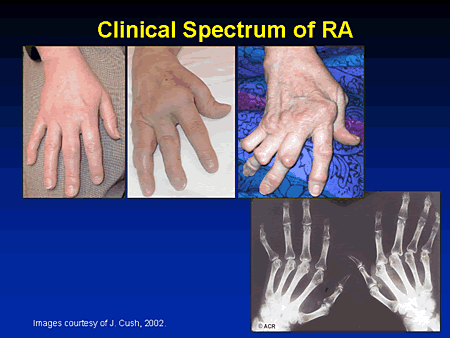 Optimizing Joint Longevity: A New Promise in the Treatment of ...
