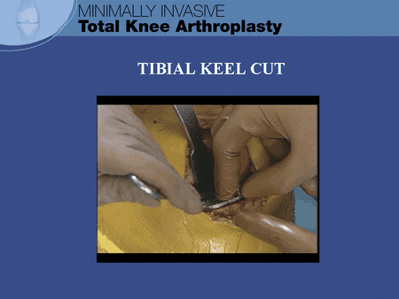Clinical Counterpoints: New Techniques in Total Knee Arthroplasty and ...