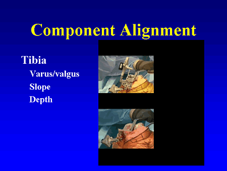 Clinical Counterpoints: New Techniques in Total Knee Arthroplasty and ...