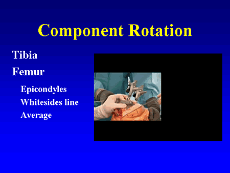 Clinical Counterpoints: New Techniques in Total Knee Arthroplasty and ...