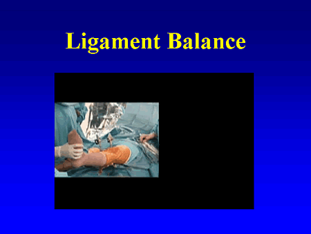 Clinical Counterpoints: New Techniques in Total Knee Arthroplasty and ...
