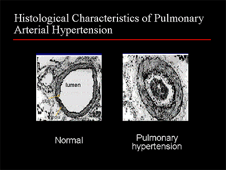 Mechanisms and Evidence-Based Management of Pulmonary Arterial ...