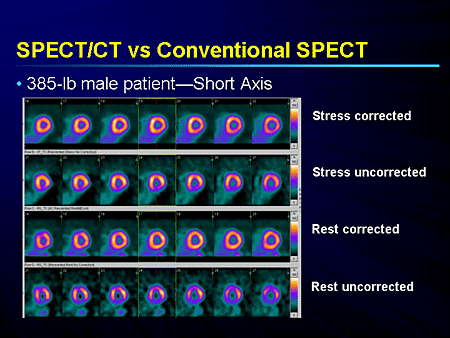 Evolving Approaches to Risk Stratification, Cardiac CT, and Attenuation ...