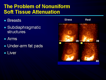 Evolving Approaches to Risk Stratification, Cardiac CT, and Attenuation ...