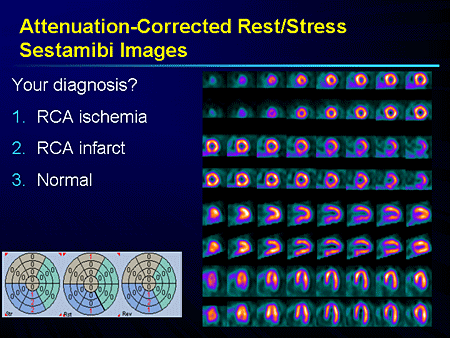 Evolving Approaches to Risk Stratification, Cardiac CT, and Attenuation ...
