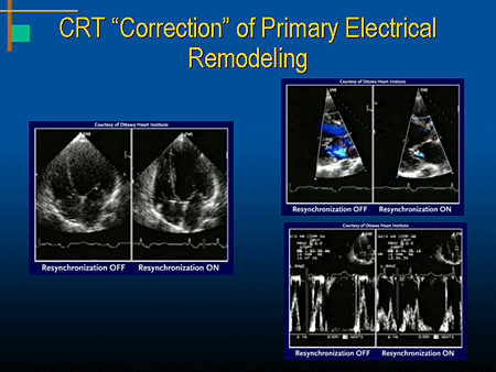 Optimizing Patient Outcome With CRT
