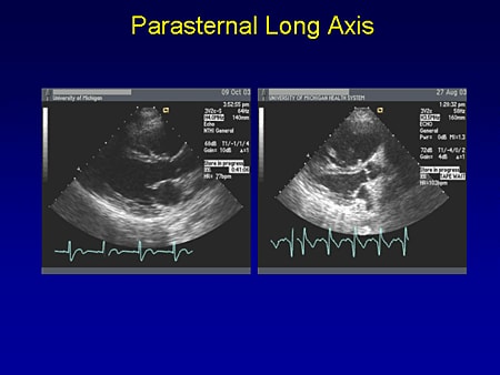PAH -- Caught in the Clinical Crossfire: A Vibrant Debate