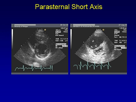 PAH -- Caught in the Clinical Crossfire: A Vibrant Debate