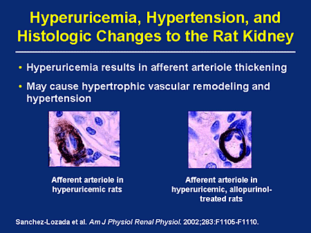 Hyperuricemia and Gout: New Clinical Insights and Emerging Treatments