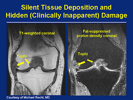 Hyperuricemia and Gout: New Clinical Insights and Emerging Treatments