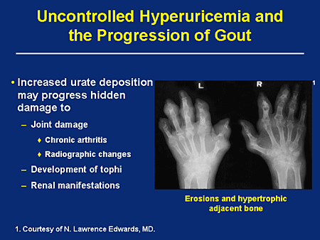 Hyperuricemia and Gout: New Clinical Insights and Emerging Treatments