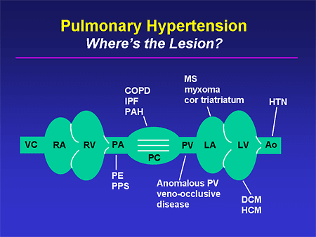 Lessons From Heart Failure for Pulmonary Arterial Hypertension (PAH)