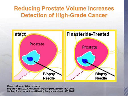 Advances in the Management of Prostate Disease: Focus on Enlarged ...