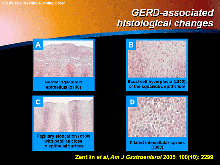 Nocturnal Gastroesophageal Reflux Disease