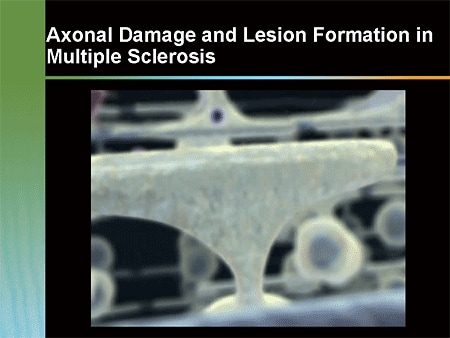 Emerging Concepts in the Pathogenesis and Treatment of MS