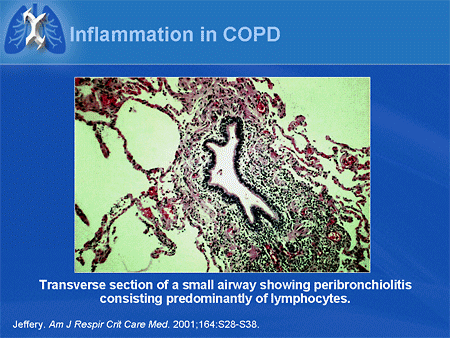 Guidelines, Pharmacotherapy, Options for Treatment of Patients With COPD