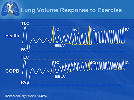 Guidelines, Pharmacotherapy, Options for Treatment of Patients With COPD