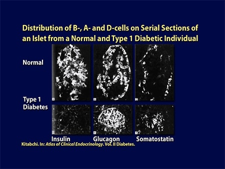 Insulin-Treated Type 2 Diabetes: Balancing Physiologic and Individual Needs