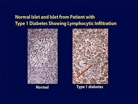 Insulin-Treated Type 2 Diabetes: Balancing Physiologic and Individual Needs