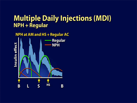 Insulin-Treated Type 2 Diabetes: Balancing Physiologic and Individual Needs
