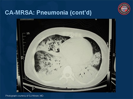 Community-Acquired and Healthcare-Associated MRS