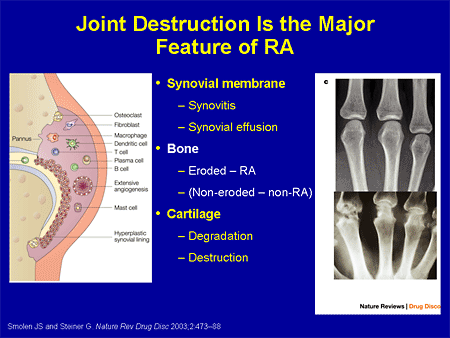 Refining the Focus: Uncoupling Inflammation and Joint Destruction