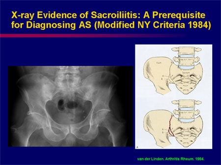 Refining the Focus: A New Look at Spondylitis