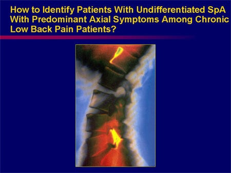 Refining the Focus: A New Look at Spondylitis
