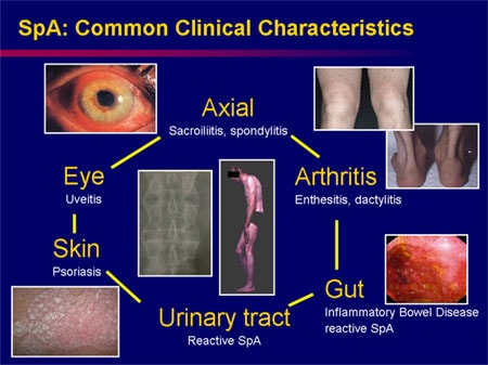 Refining the Focus: A New Look at Spondylitis