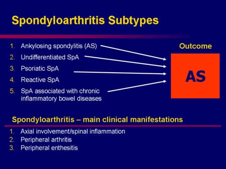 Refining the Focus: A New Look at Spondylitis