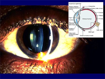 Refining the Focus: A New Look at Spondylitis