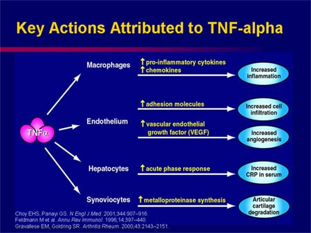 Refining the Focus: A New Look at Spondylitis