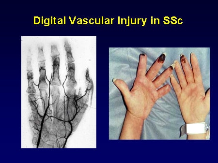 Vascular Complications of Systemic Sclerosis