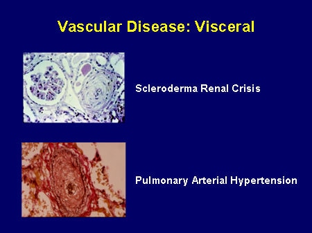 Vascular Complications of Systemic Sclerosis