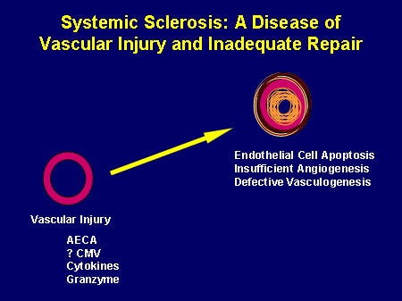 Vascular Complications of Systemic Sclerosis
