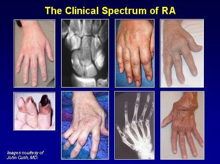 Changing the Treatment of Rheumatic Diseases: Optimal Use of Biologic ...